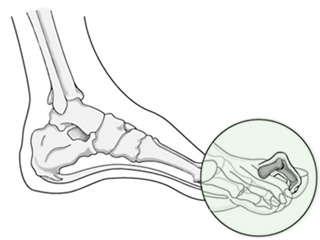 Hamertenen en Klauwtenen behandelen | Podologie Hermanns