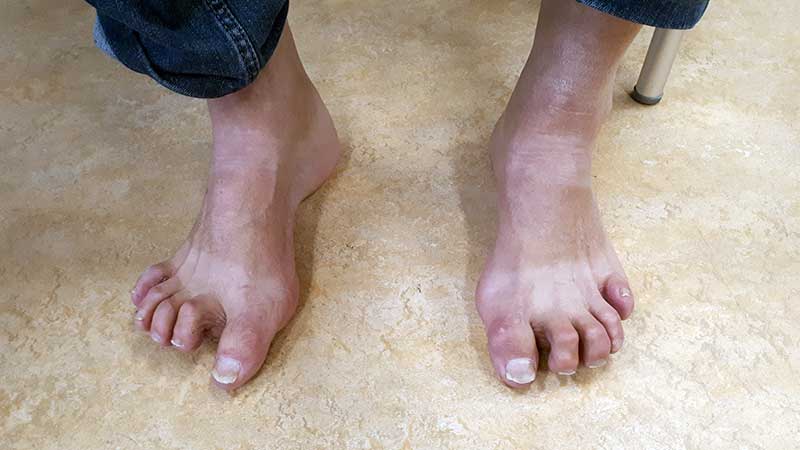 Holvoet klachten behandelen | Podologie Hermanns